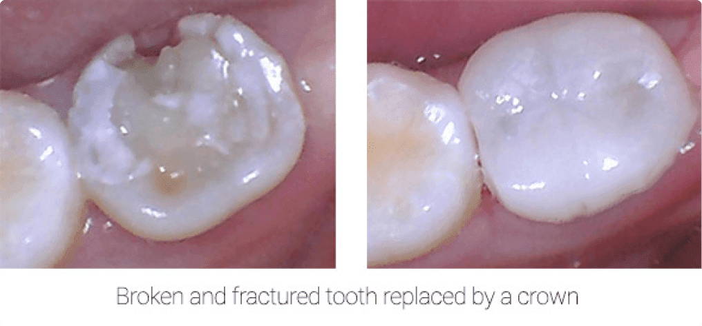 Dental Crowns Brooklyn - CEREC, PFZ, Zirconium, Ceramic Crowns