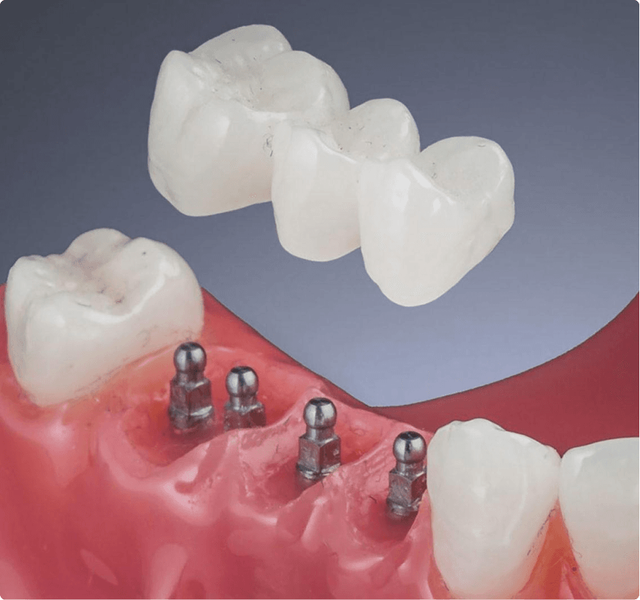 Mini Dental Implants | LuxDen Dental Implants Center | Brooklyn NY