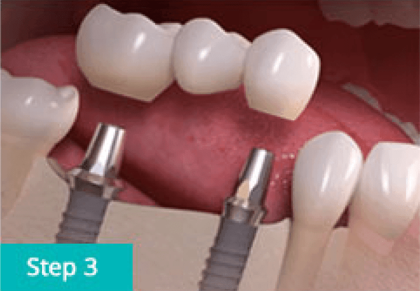 Missing Multiple Teeth | Dental Implants Center in Brooklyn NY