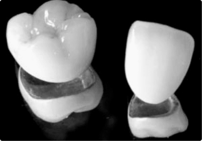 Dental Crowns Brooklyn - CEREC, PFZ, Zirconium, Ceramic Crowns